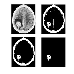 Wavelet Based Image Fusion for Brain Tumor Detection - file plus